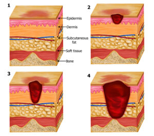 Pressure Sores are Preventable